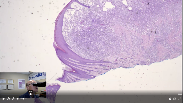 Rapidly growing exophytic skin-colored lesion in a child | Dermpedia