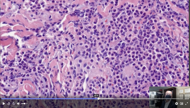 Pyoderma gangrenosum versus infectious ulcer