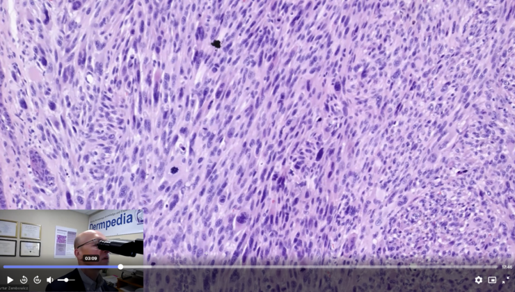 Atypical fibroxanthoma with expression of ERG