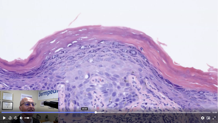 "Unusual" usual VIN arising in chronic lichen sclerosus | Dermpedia