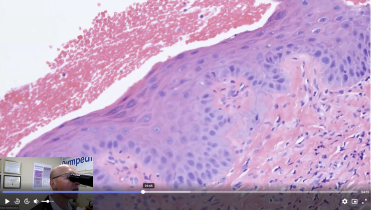 Classic differentiated, HPV-independent, VIN