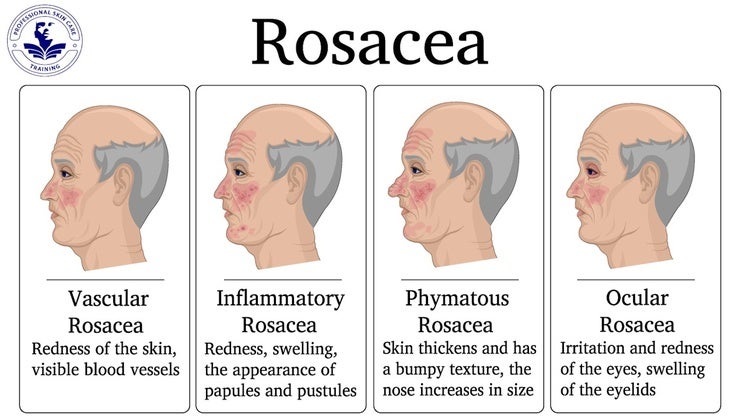 Rosacea Subtypes PDF | Pro Skin Care Training