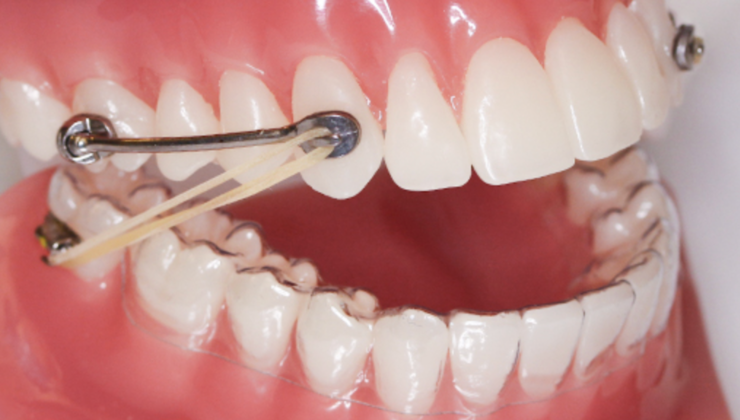 Quick Tip - Combining Aligners with the Carriere Motion Appliance ...