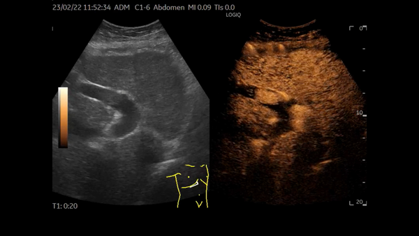 Ultrasonografie cu contrast (CEUS). Aplicatii in terapia intensiva ...