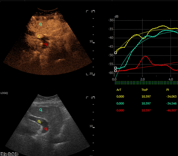 Ultrasonografie cu contrast (CEUS). Aplicatii in terapia intensiva ...