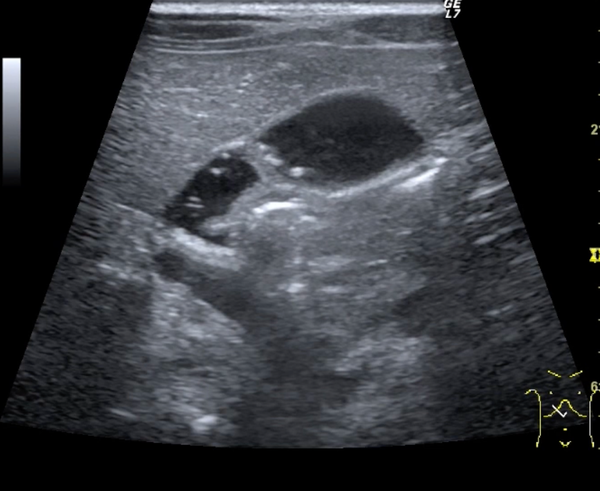 Ultrasonografia clinica a etajului abdominal superior. Ficat. Colecist ...