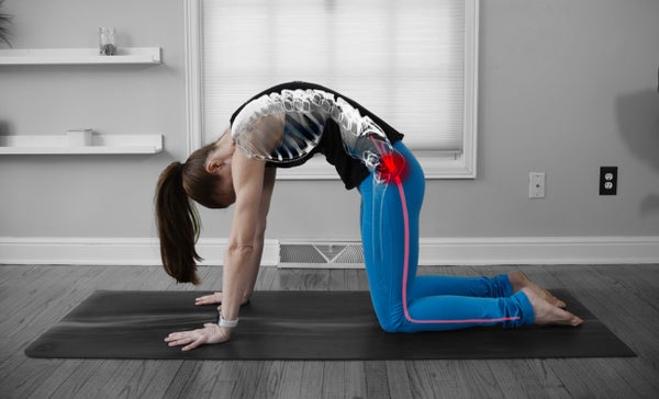 Sciatica Test 2024 - Version A