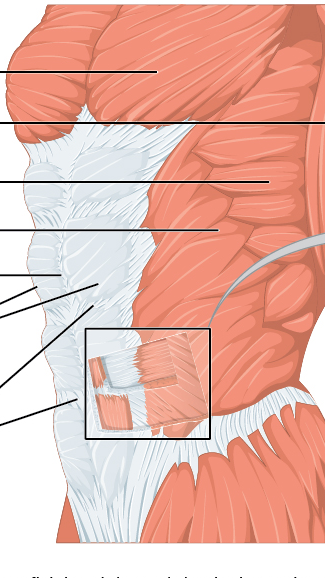 What is Diastasis Recti?