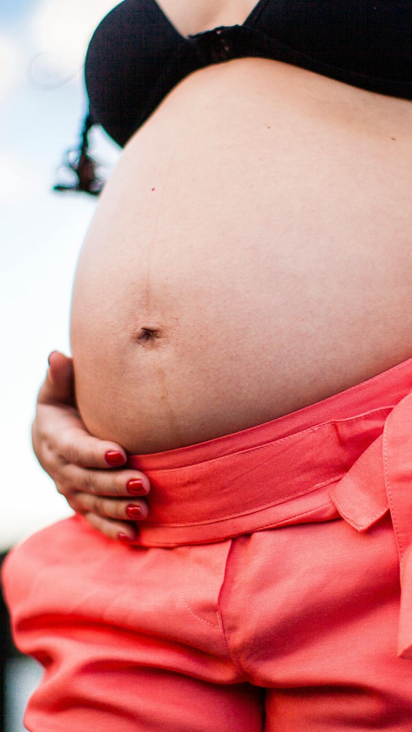 What is Diastasis Recti?