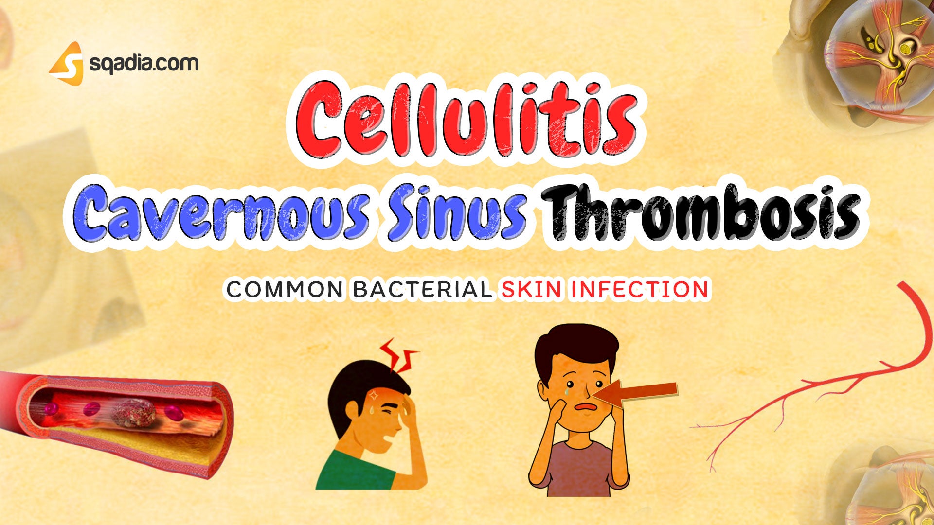 Cavernous Sinus Thrombosis