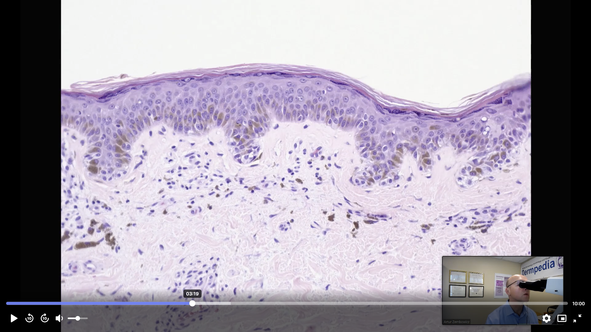 Severely atypical dysplastic nevus with regression | Dermpedia