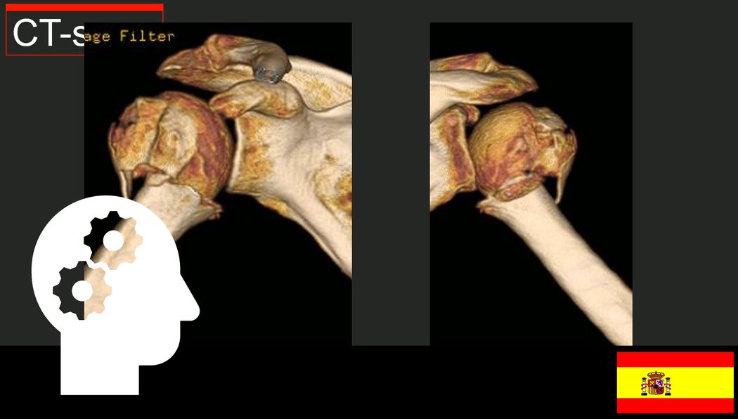 Fractura de Humero Proximal Reducción Abierta y Fijación