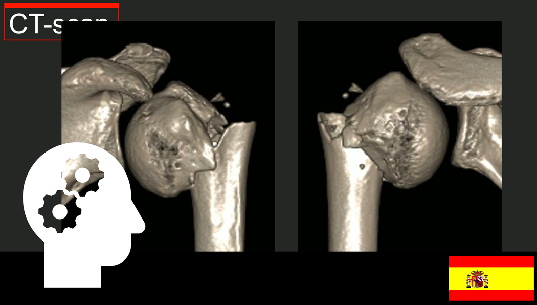 Fractura de Humero Proximal - Reducción Abierta y Fijación