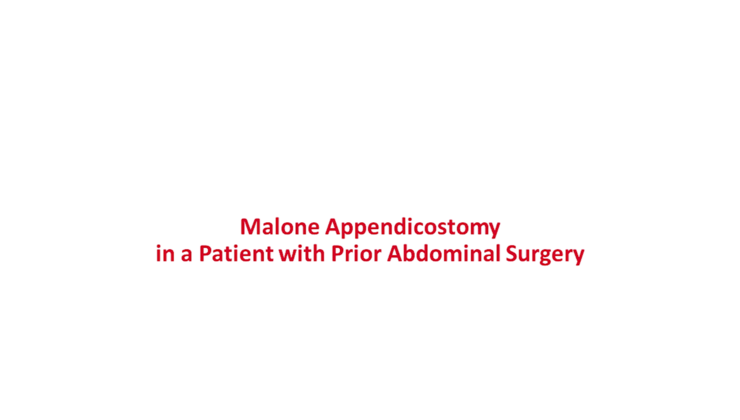 Experts in Surgery | Malone Appendicostomy in a Patient with Prior ...