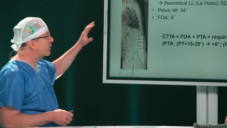 Case Introduction - Pedicle Subtraction Osteotomy in Fixed Lumbar ...