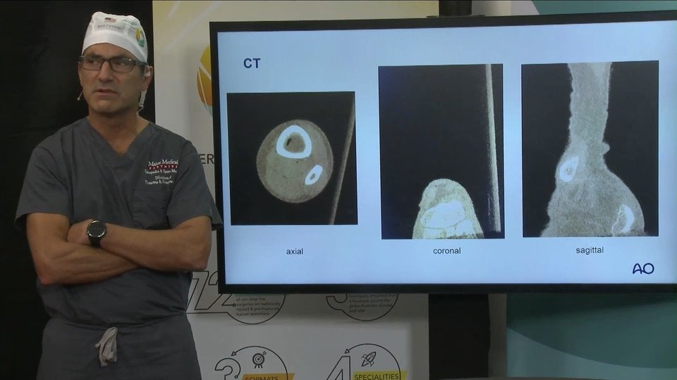 Case Introduction - Minimally Invasive Plate Osteosynthesis vs. Open ...