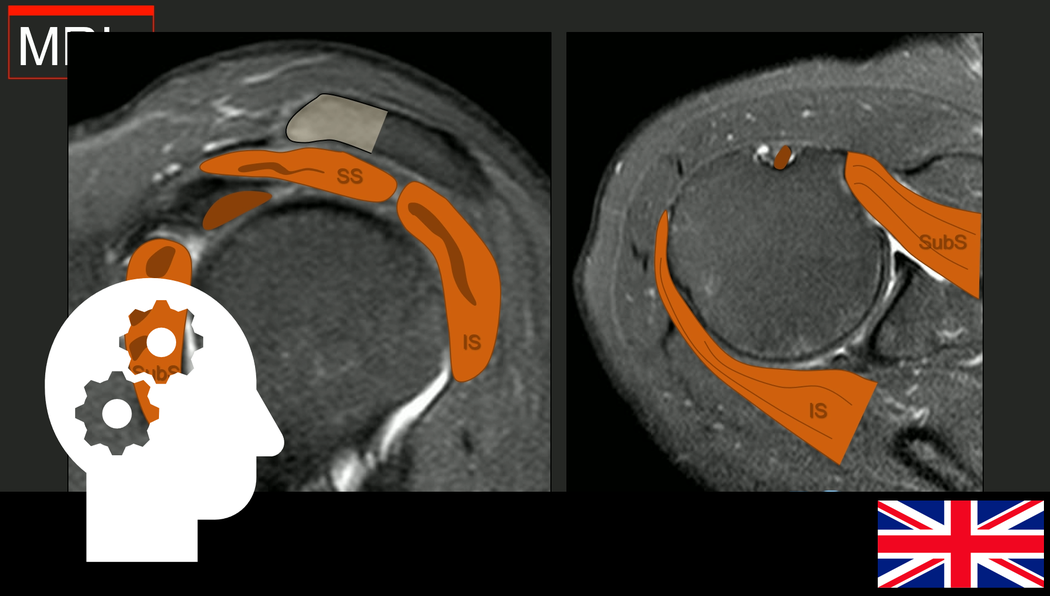 Subacromial impingement syndrome and tear of supraspinatus