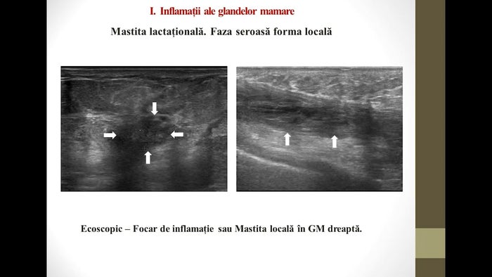 Ultrasonografia mamara