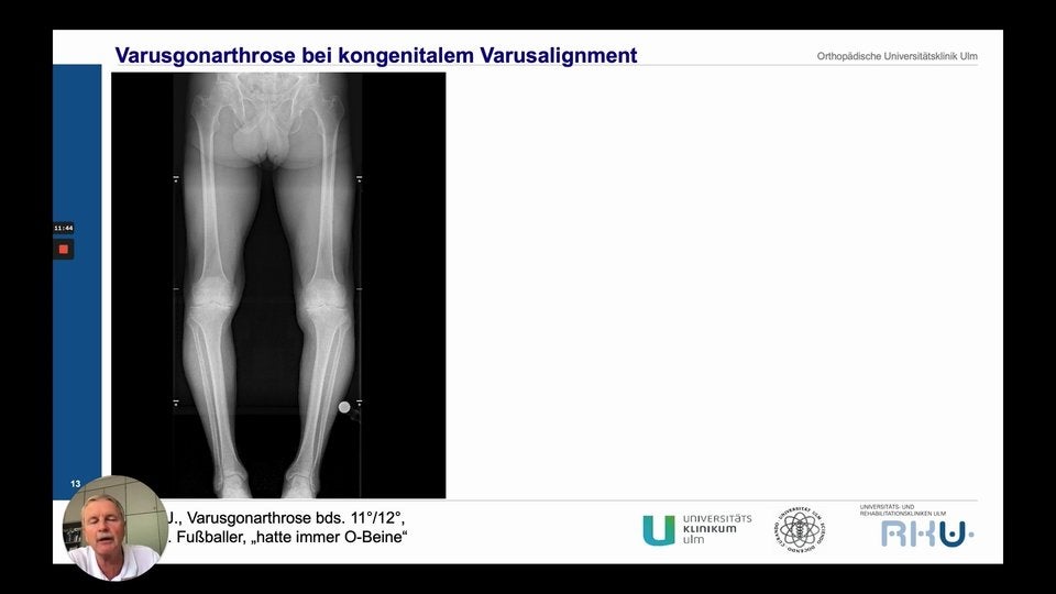 Case Introduction - Robotically Assisted Total Knee Arthroplasty (TKA ...