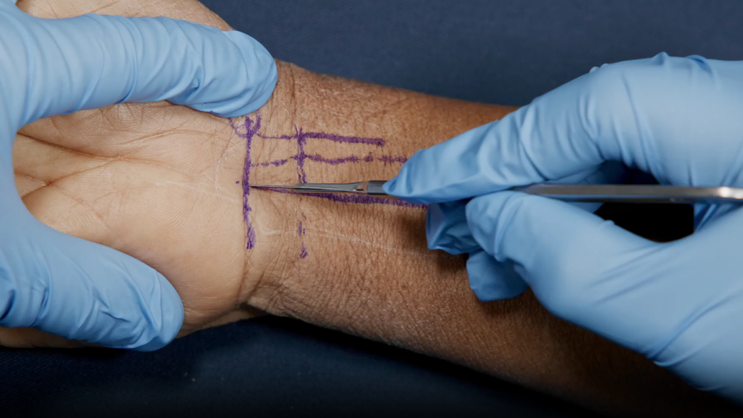 Palmar Approach to the Ulnar Corner of the Distal Radius