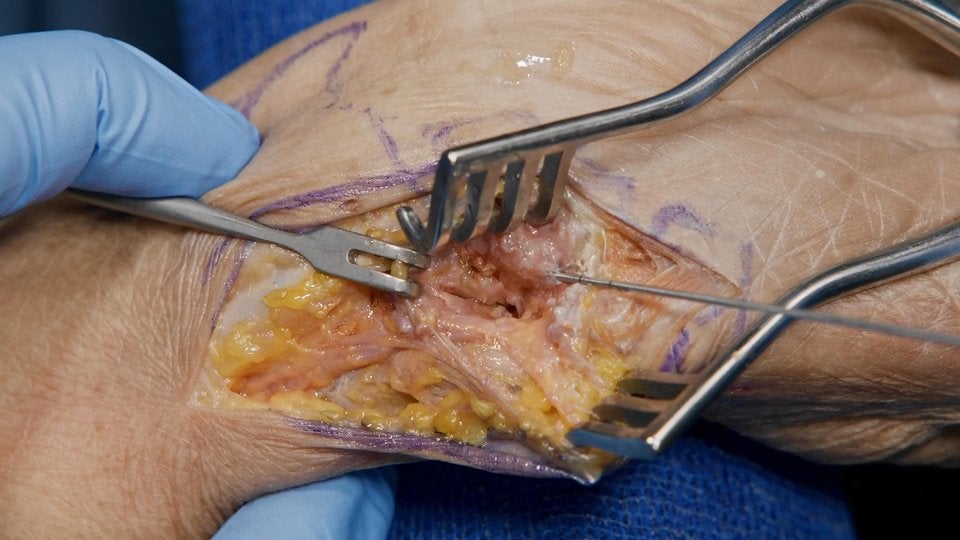 Surgery - Scaphoid Fractures