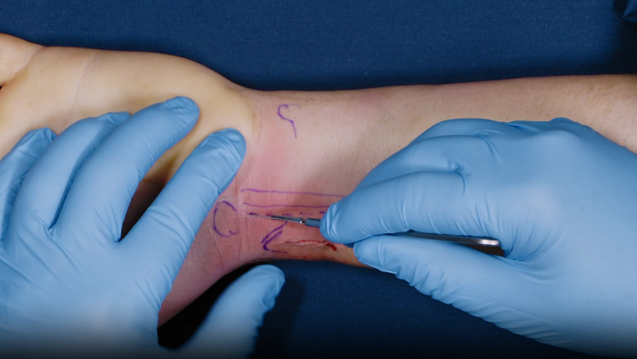 Palmar Approach – Modified Henry Approach to the Distal Forearm