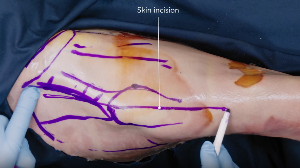 Surgical Dislocation Of The Hip Through A Modified Gibson Approach