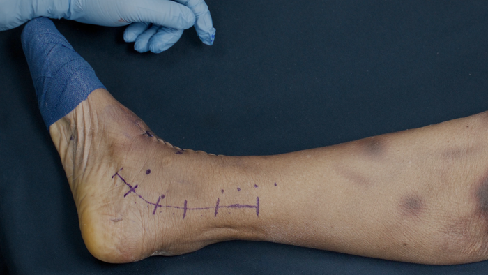 Posteromedial Approach to the Distal Tibia