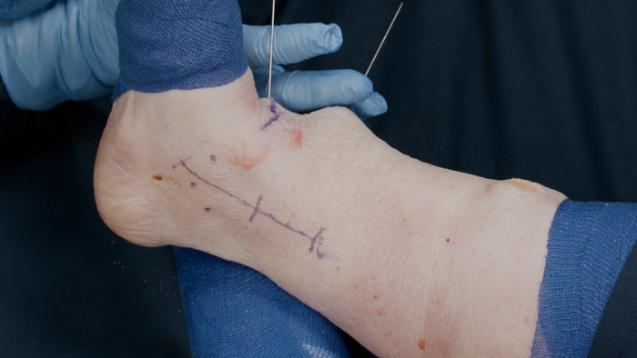 Medial Approach to the Distal Tibia
