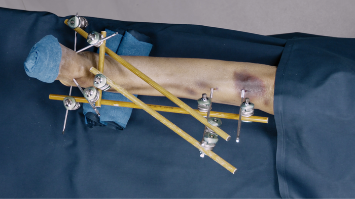 Techniques for the Treatment of Distal Tibia Fractures - Application of ...