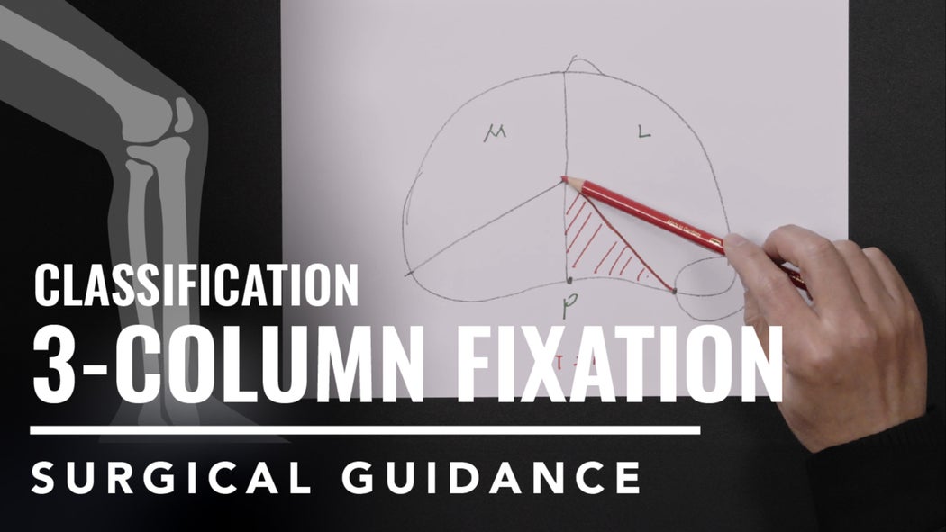 Tibial Plateau Fractures: Three-Column Fixation