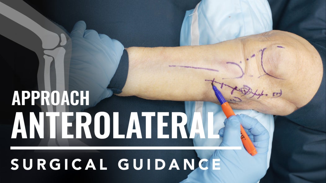 Anterolateral Approach to the Proximal Tibia in Supine Position