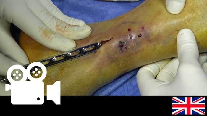 Distal tibia fracture: minimally invasive plate MIPO