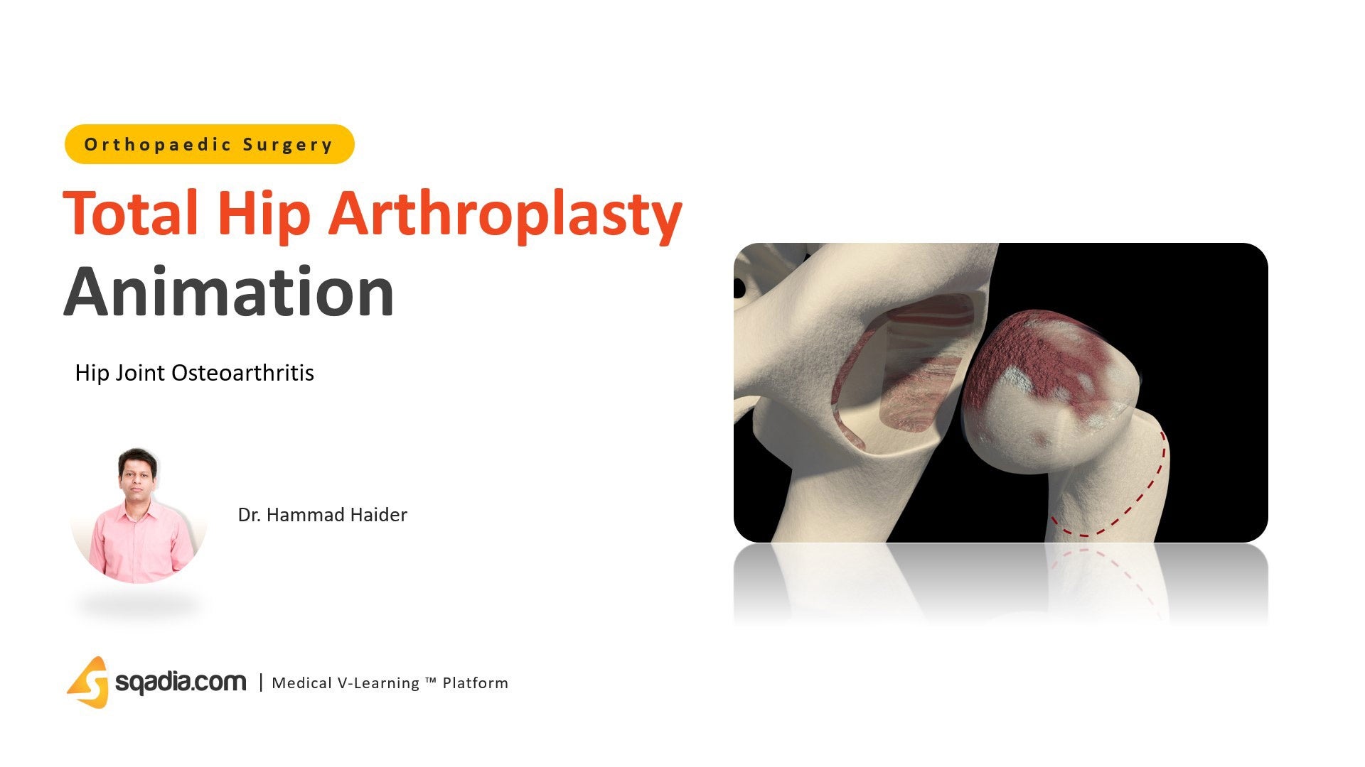 Osteoarthritis Animation