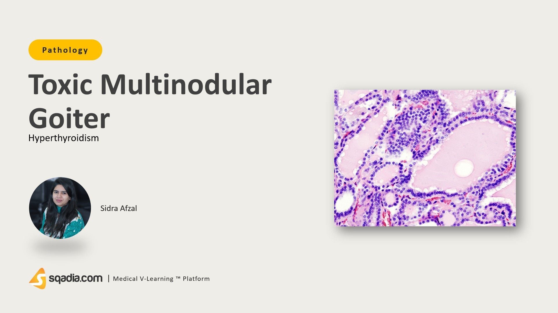 Hyperthyroidism Toxic Multinodular Goiter hyperthyroidism-toxic-multinodular-goiter