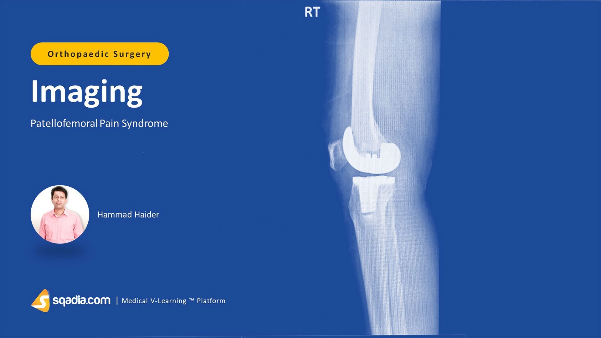 Patellofemoral Pain Syndrome X Ray